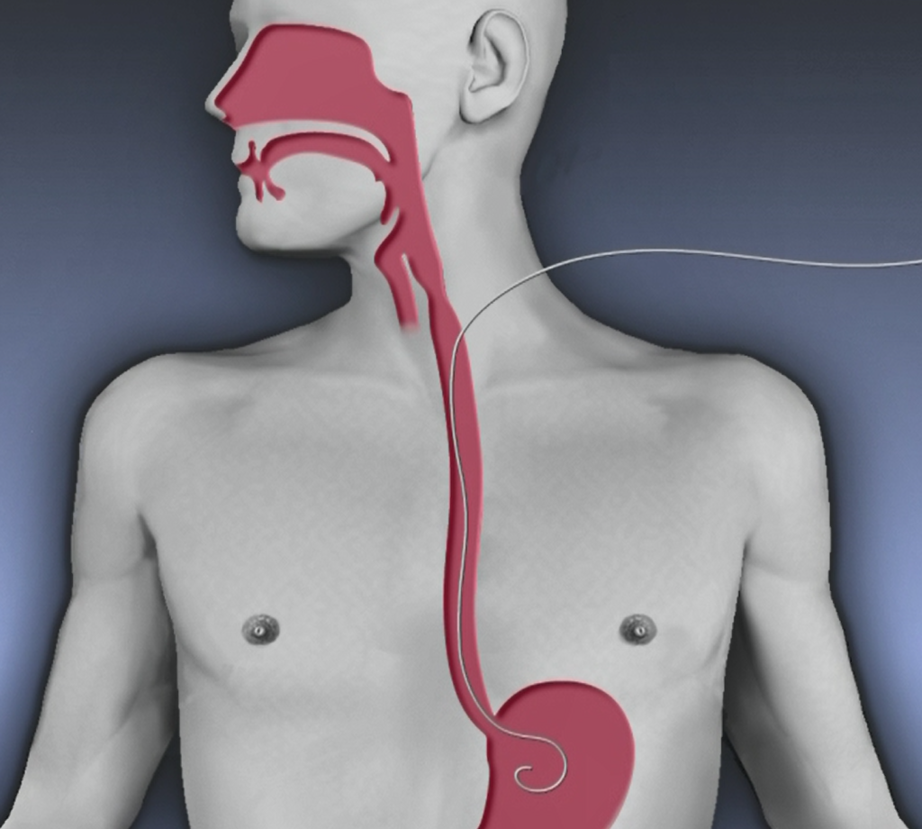 PTEG造設方法 – 廿日市記念病院